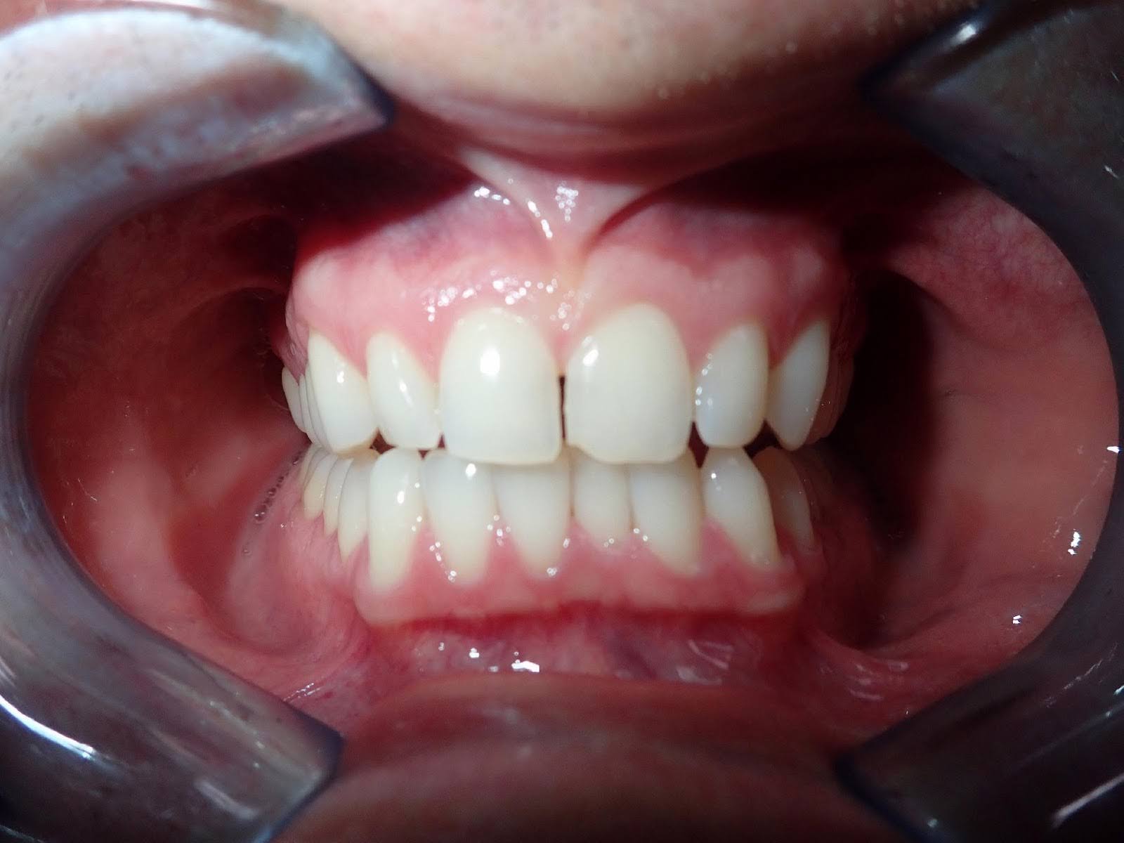 Before and After | Moseley Dental Group | Dallas TX 752253